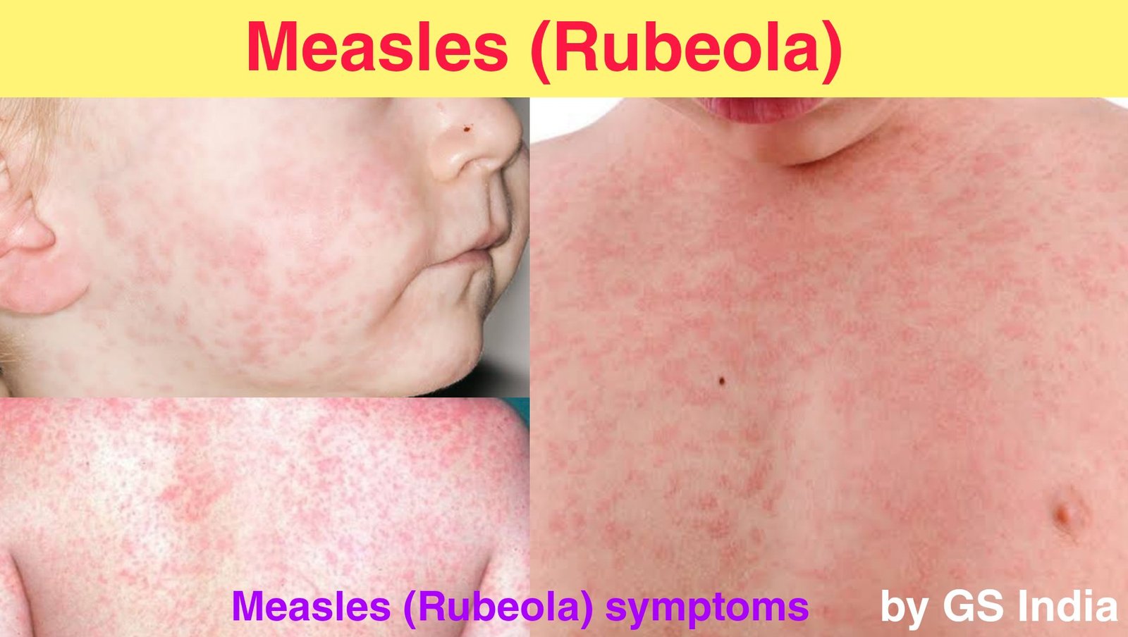 Measles (rubeola)-Sign & Symptoms, Measles Stages, measles vaccine, Measles and German measles ...