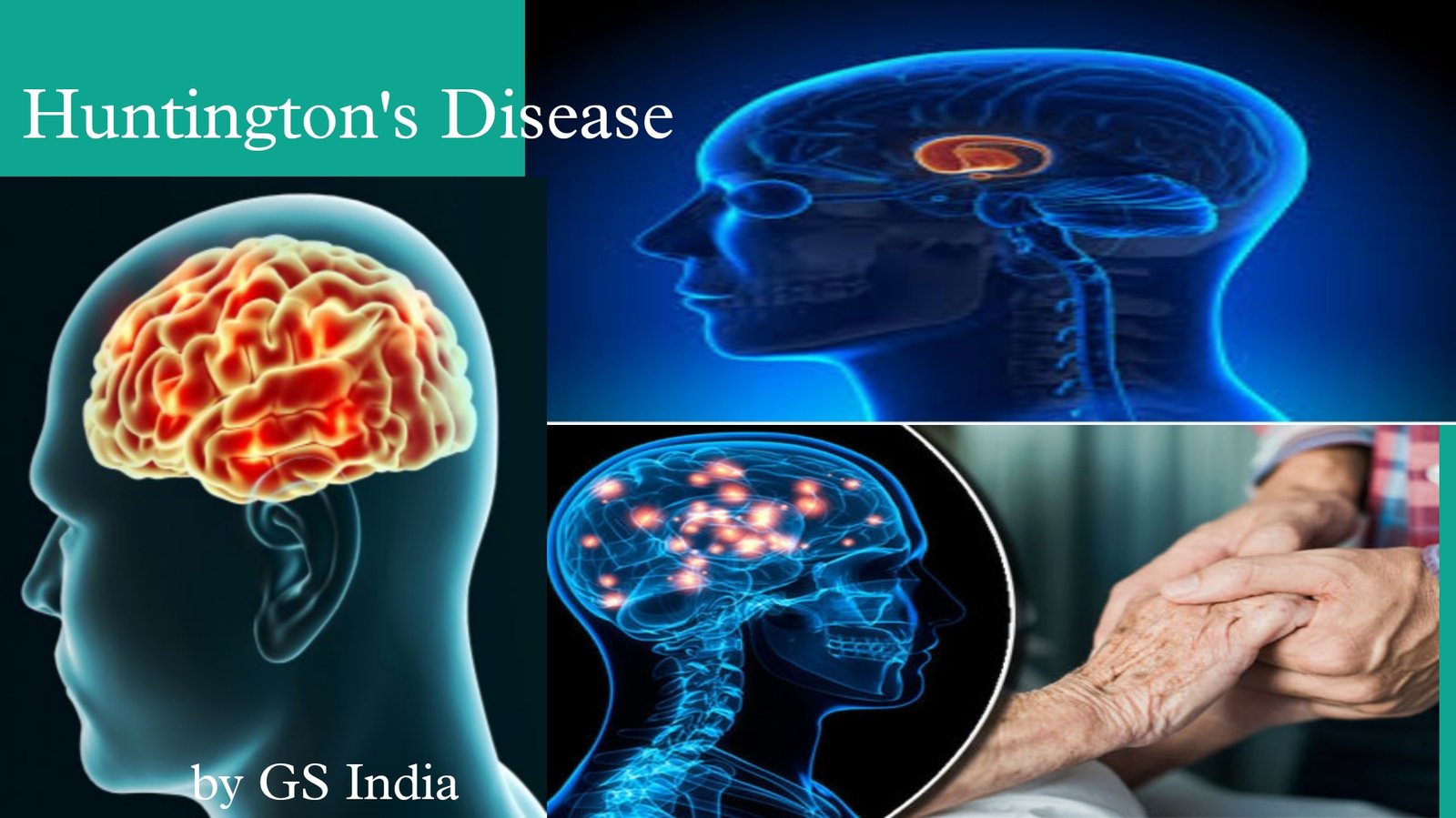 Huntington's Disease, sign & symptoms, diagnosis & treatment of ...