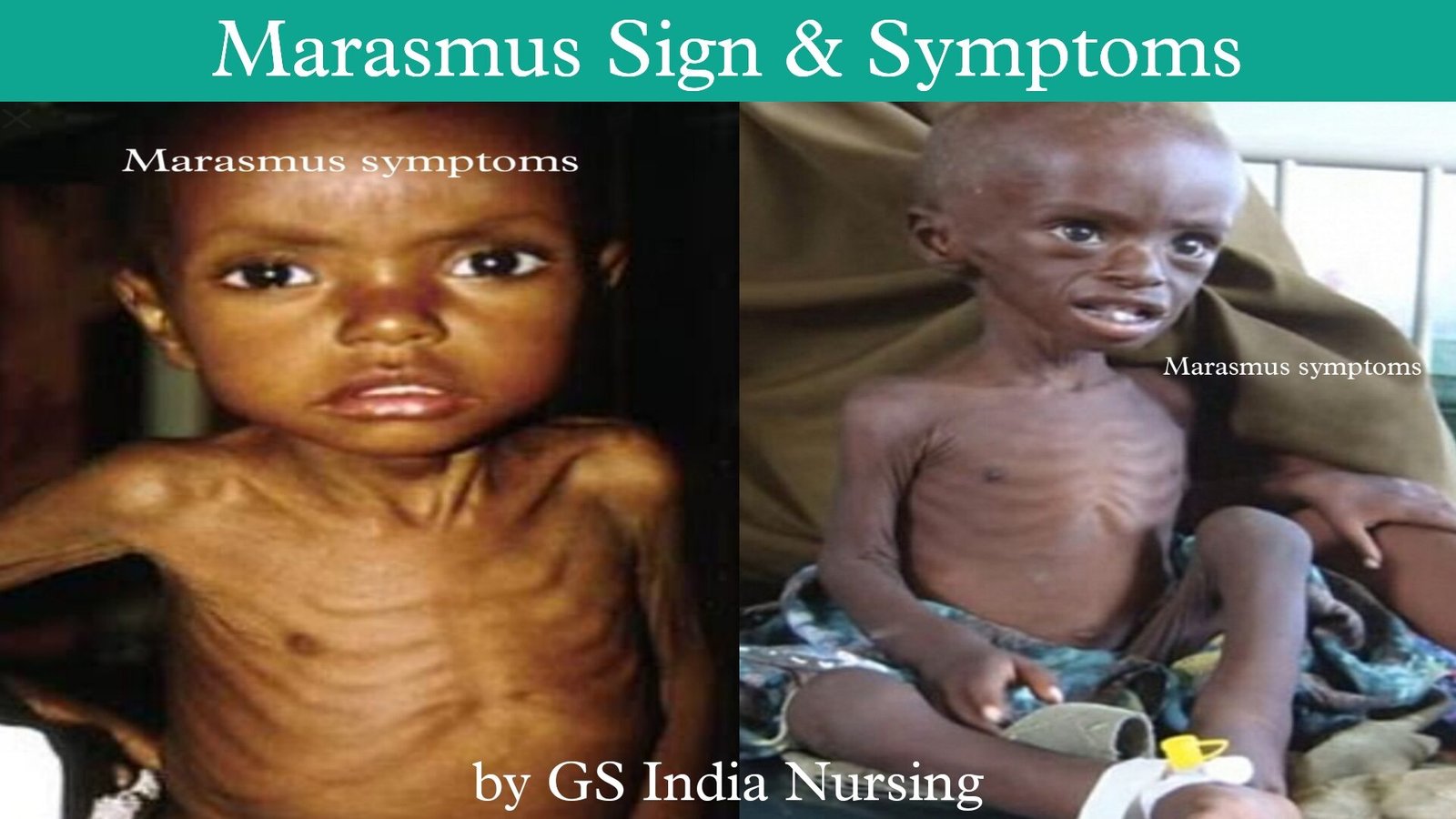 Marasmus Disease (PEM), Causes, Sign & Symptoms, diagnosis,,prevention ...