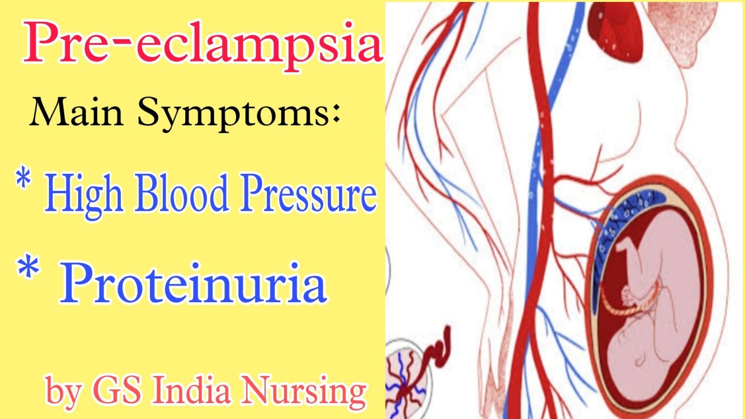 Pre Eclampsia Pre Eclampsia Definition Causes And Symptoms Diagnosis