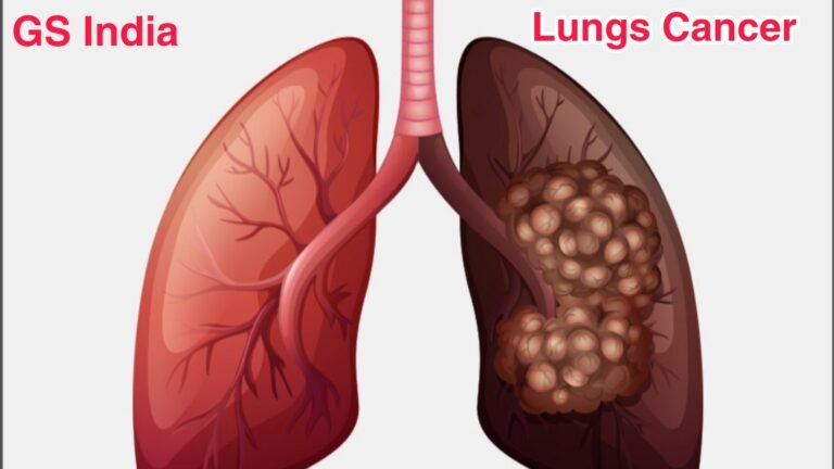 Lung Cancer, Definition of Lung Cancer, Types & Causes, Symptoms ...