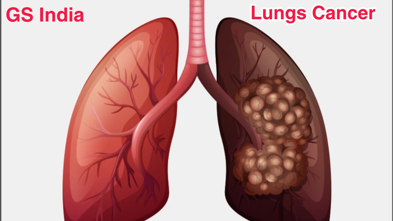 Lung Cancer, Definition of Lung Cancer, Types & Causes, Symptoms ...